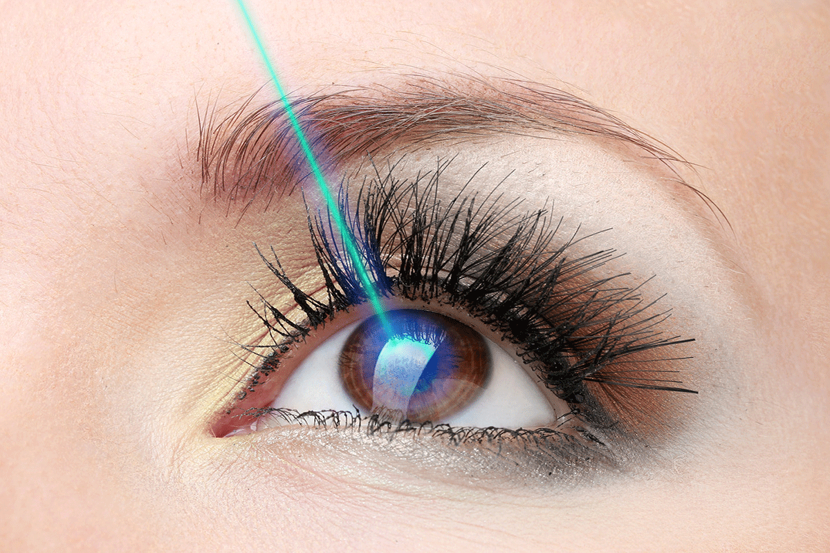 Non-invasive laser used to correct myopia - Insight
