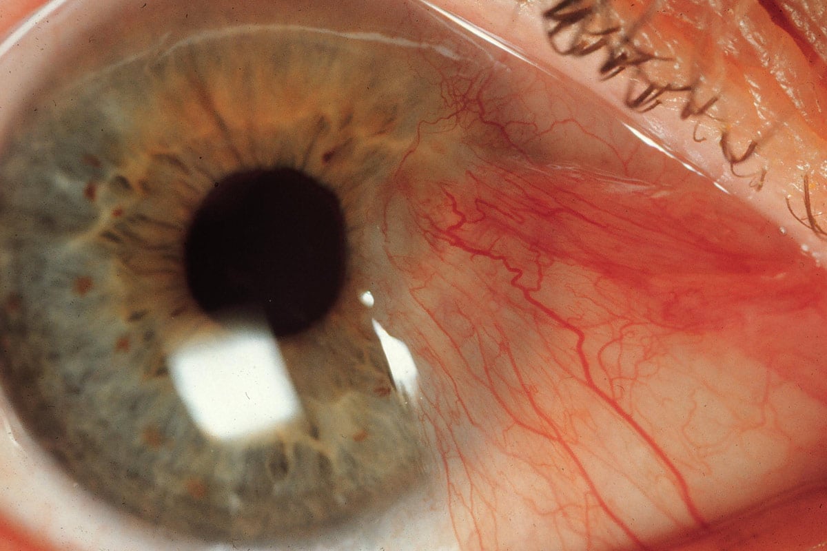 Surfer?s eye a possible sign of cancer - Insight