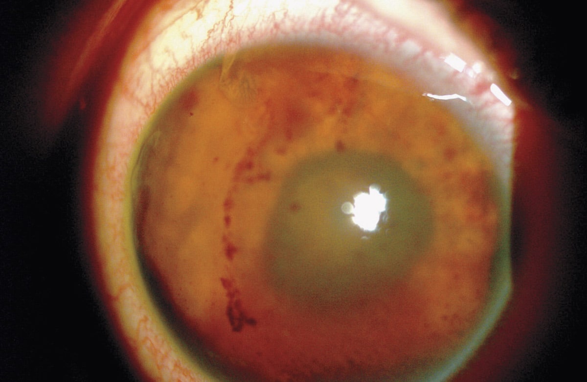 Shocking video: parasitic worm found in eyeball - Insight