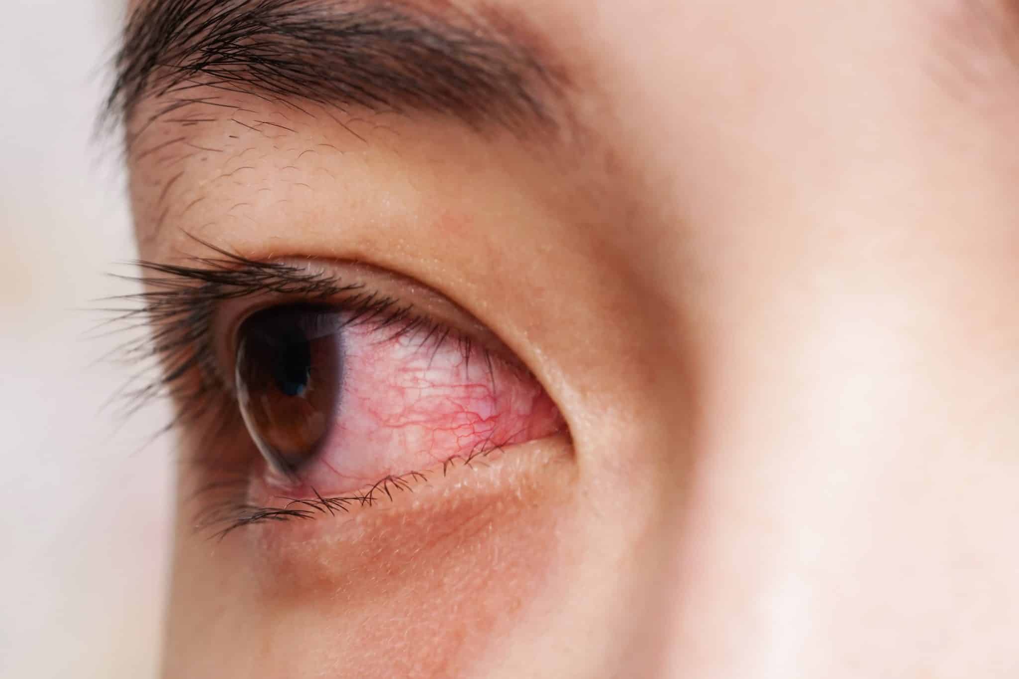 Study findings suggest coronavirus replicates in the eye - Insight
