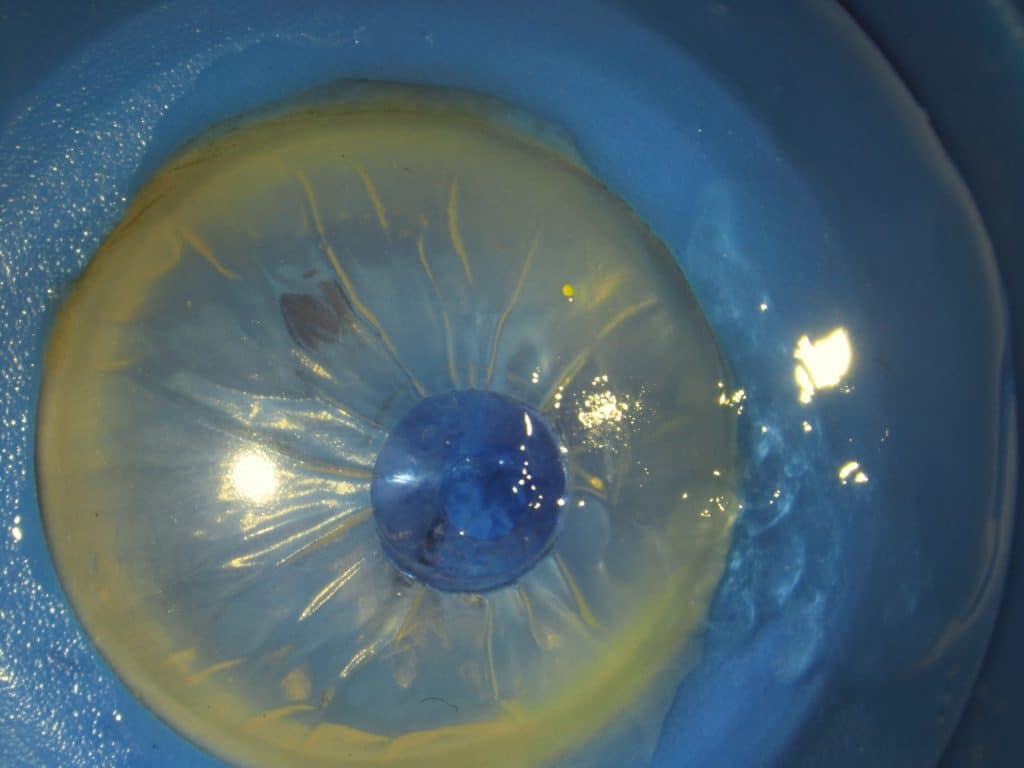Sydney ophthalmologist develops synthetic gel for corneal injuries ...
