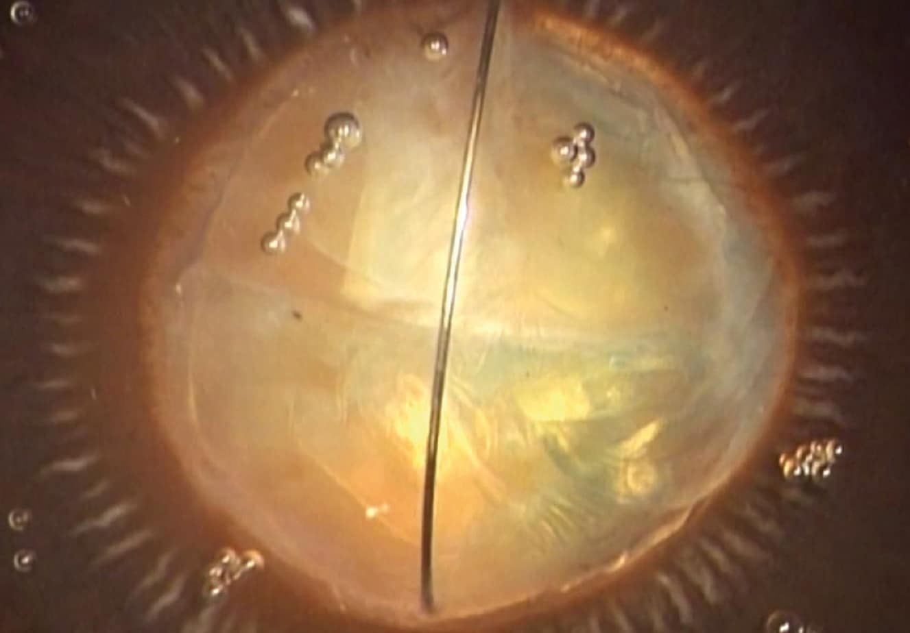 Queensland surgeon performs first-of-kind cataract technique - Insight