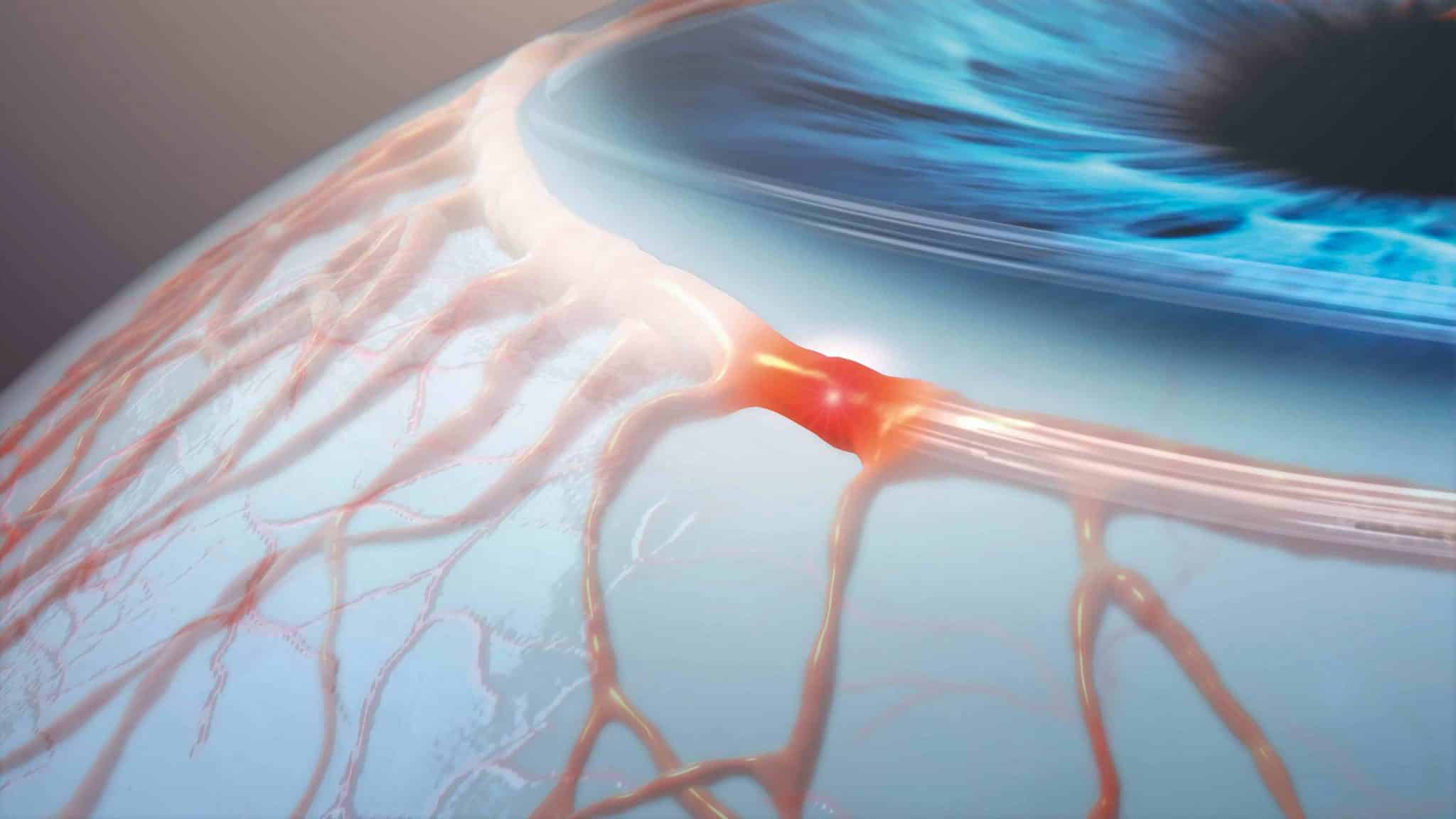 New iTrack trial comparing efficacy and safety ab-interno canaloplasty ...