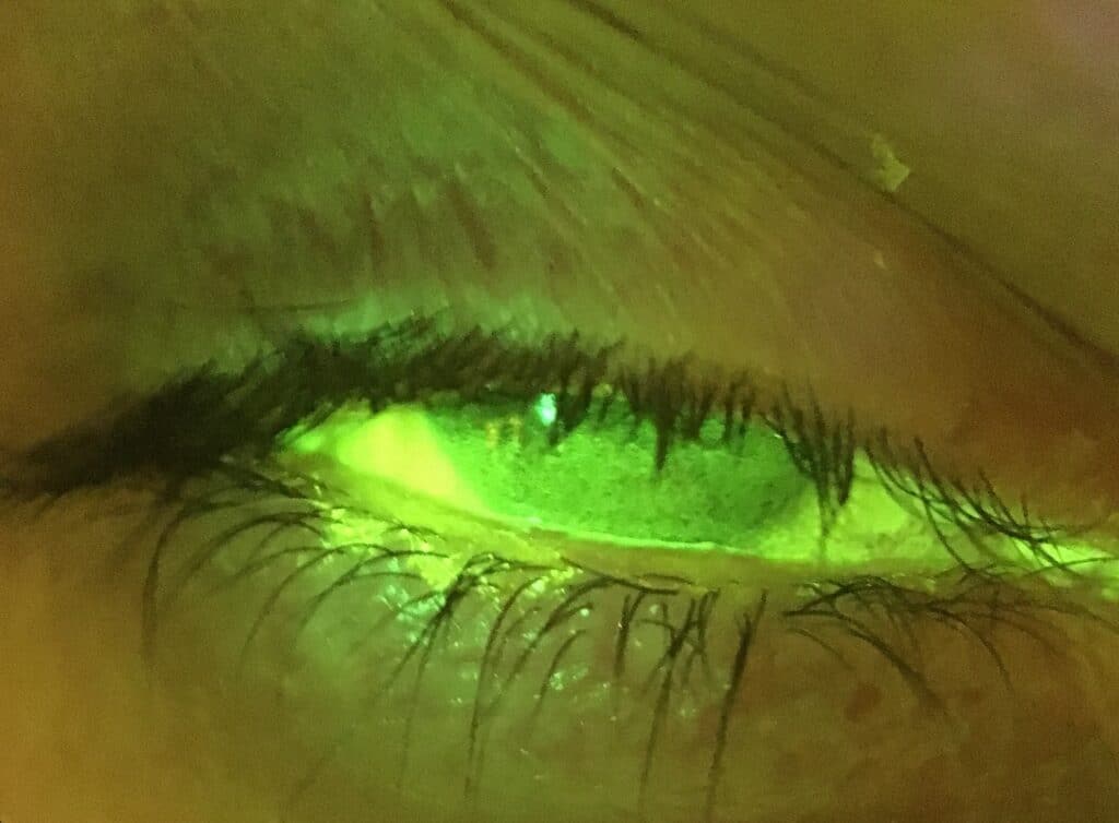 Understanding new treatment protocols for severe dry eye - Insight