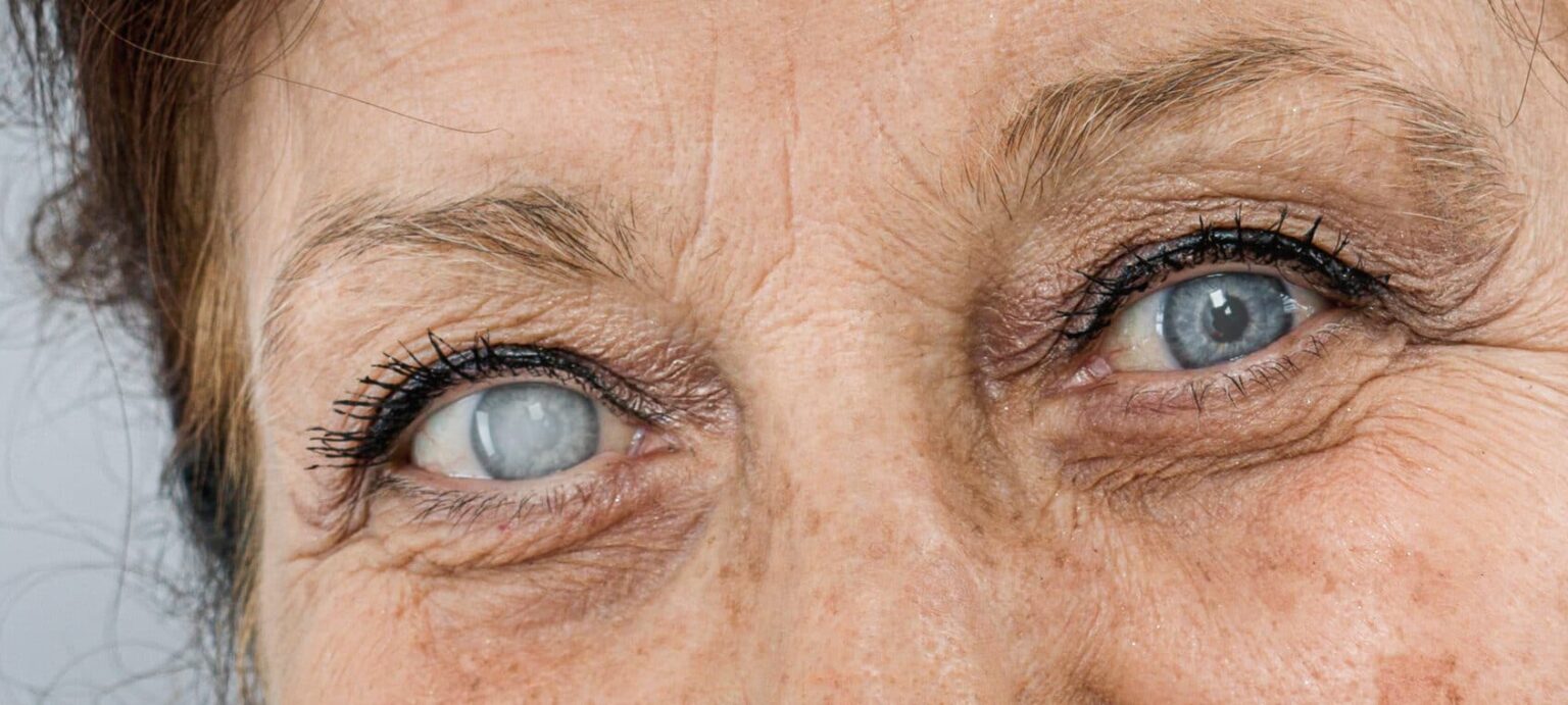World-first Aussie research studies genetics of cataracts - Insight