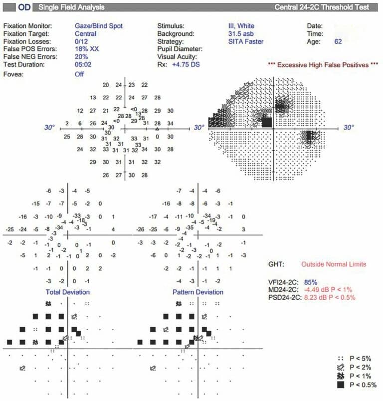 Unilateral glaucoma or historic non-arteritic anterior ischaemic optic ...