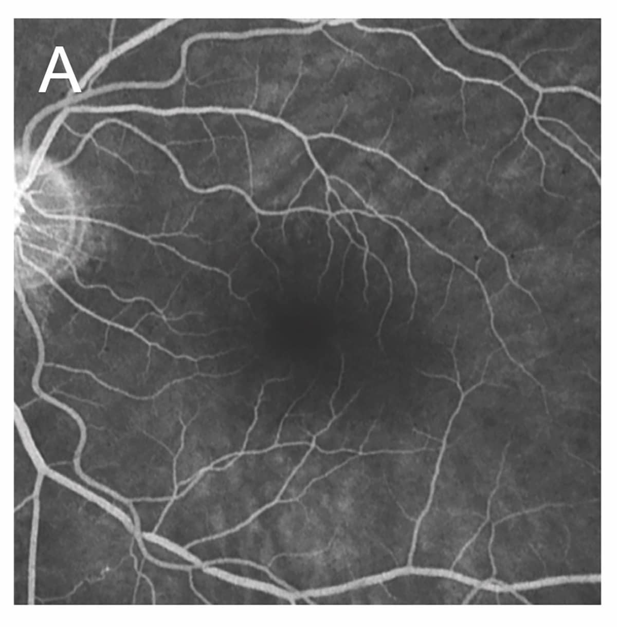 OCT-A in macular disorders: tips, tricks and practical clinical use ...