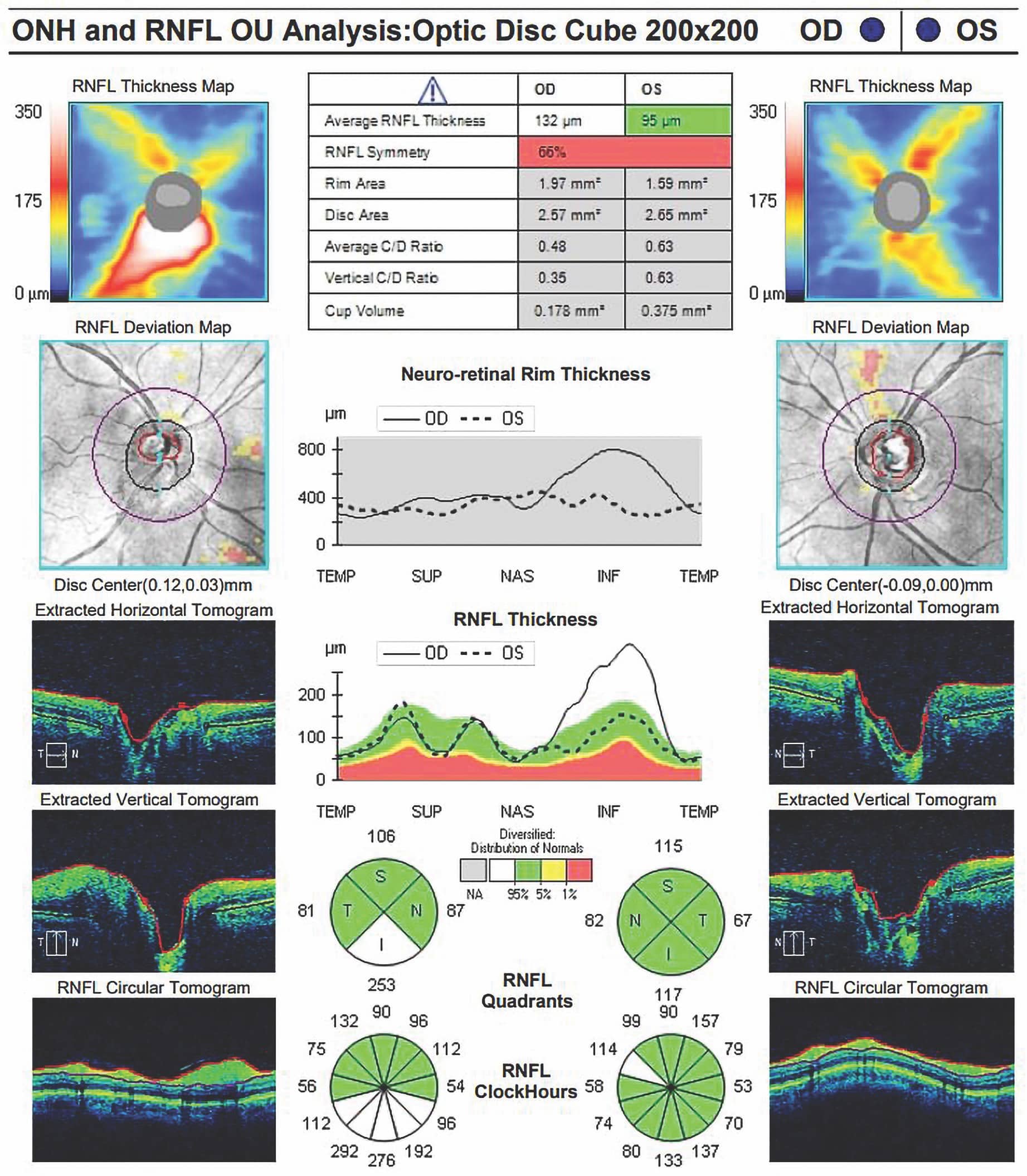 Unilateral glaucoma or historic non-arteritic anterior ischaemic optic ...