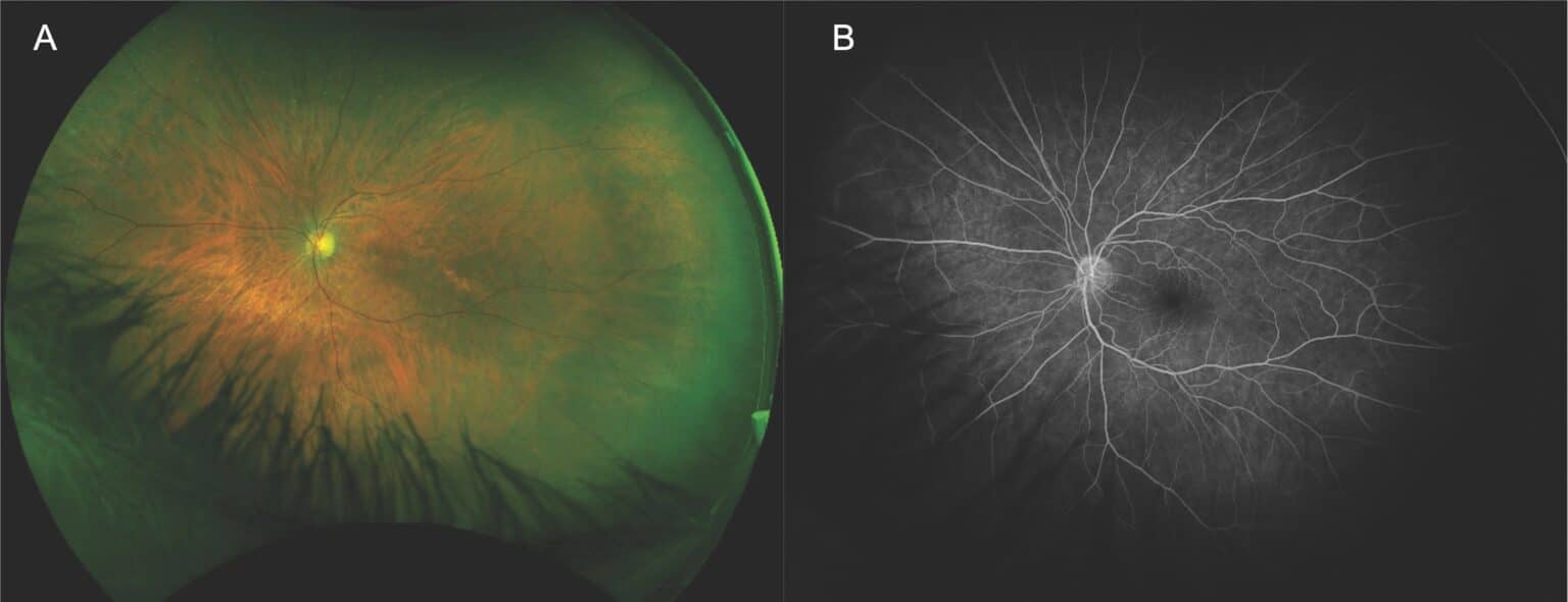 OCT-A in macular disorders: tips, tricks and practical clinical use ...