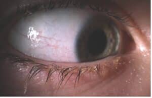 Demodex infestation: Diagnosis and management - Insight