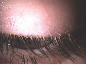 Demodex infestation: Diagnosis and management - Insight