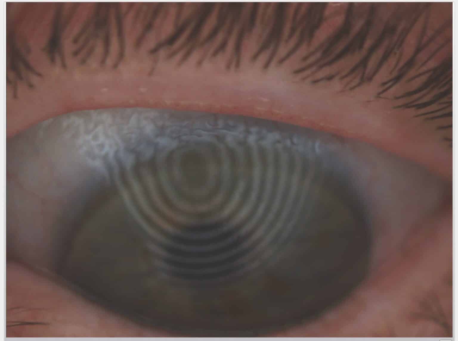 Dry eye – a multifactorial approach to a multifactorial disease - Insight