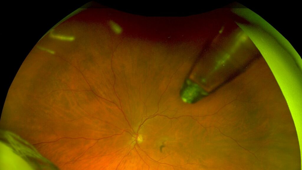 Port delivery system for neovascular AMD – A/Prof Anthony Kwan - Insight