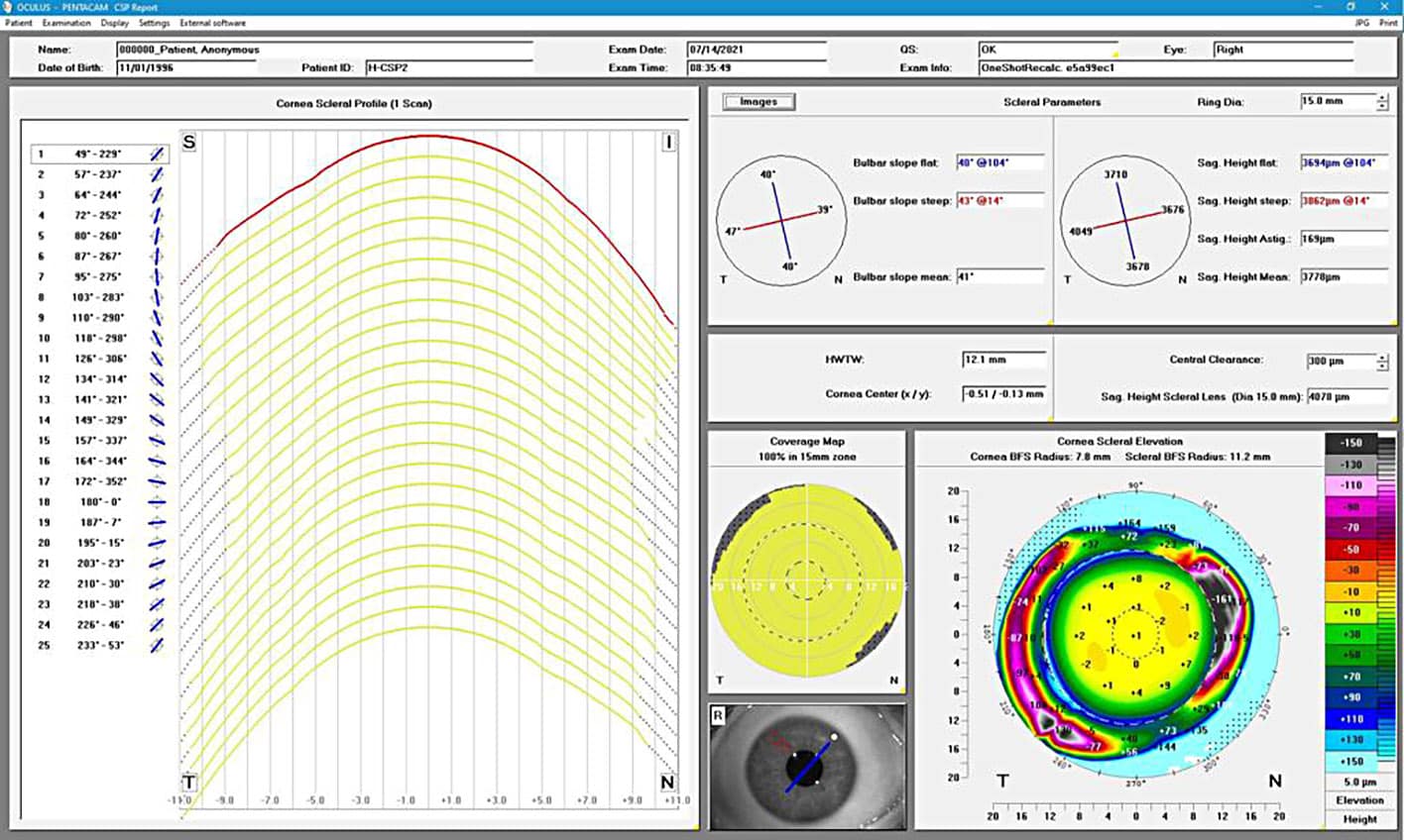 Pentacam – the centrepiece in a specialty contact lens clinic - Insight