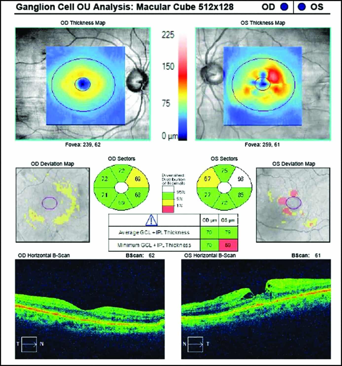 Seven common errors in glaucoma management – and how to avoid them ...