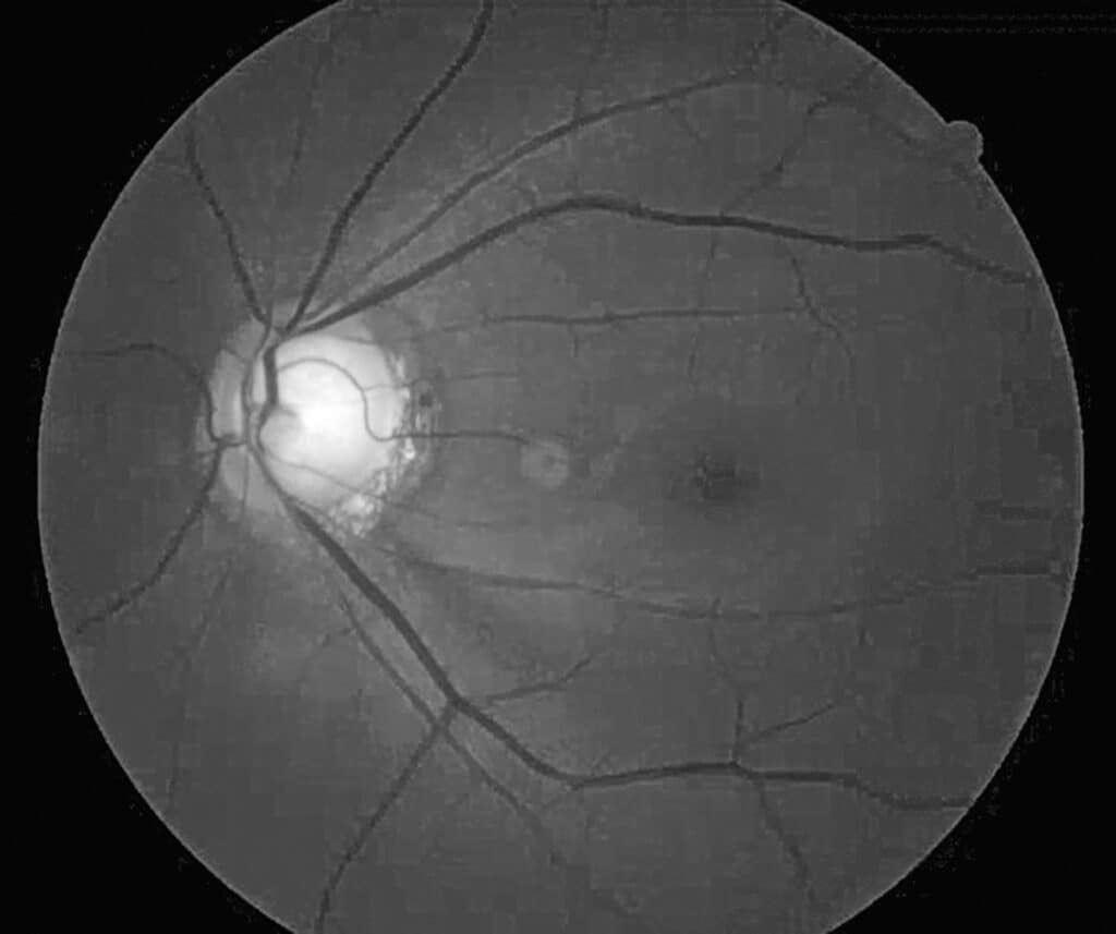 Seven common errors in glaucoma management – and how to avoid them ...