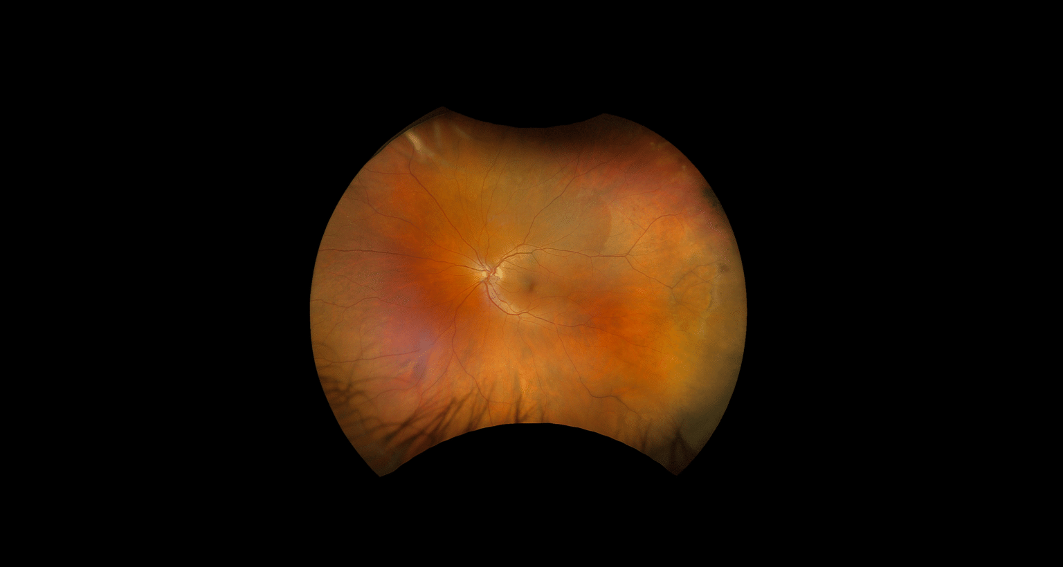 New optomap ultra-widefield colour image modality provides additional ...