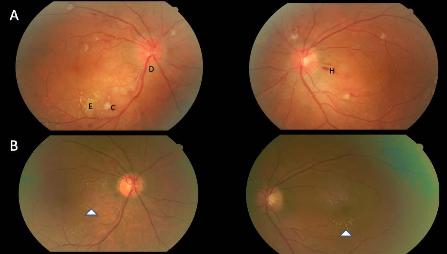 Ocular associations in pregnancy - Insight