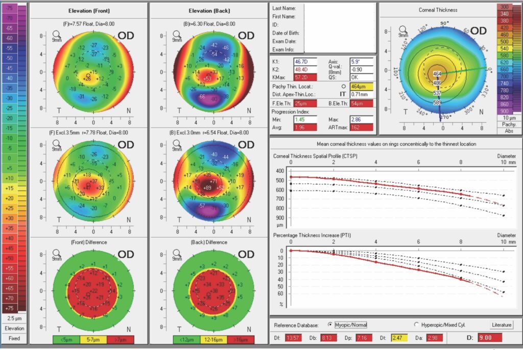The role of the optometrist in keratoconus - Insight