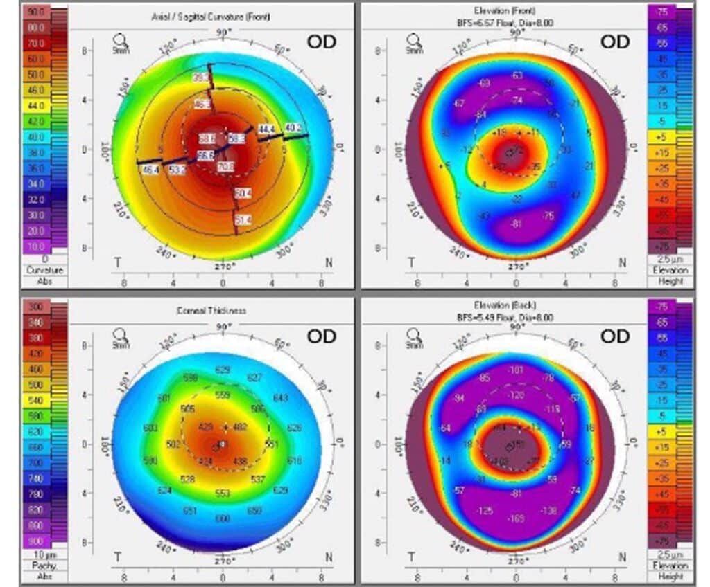 Keratoconus: A frank discussion with Abi Tenen - Insight