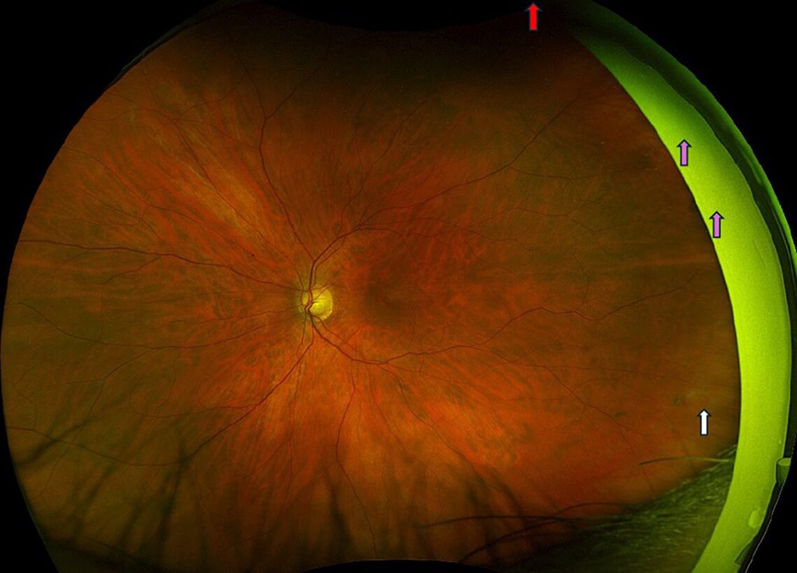 Posterior vitreous detachment: Minimising complications through ...