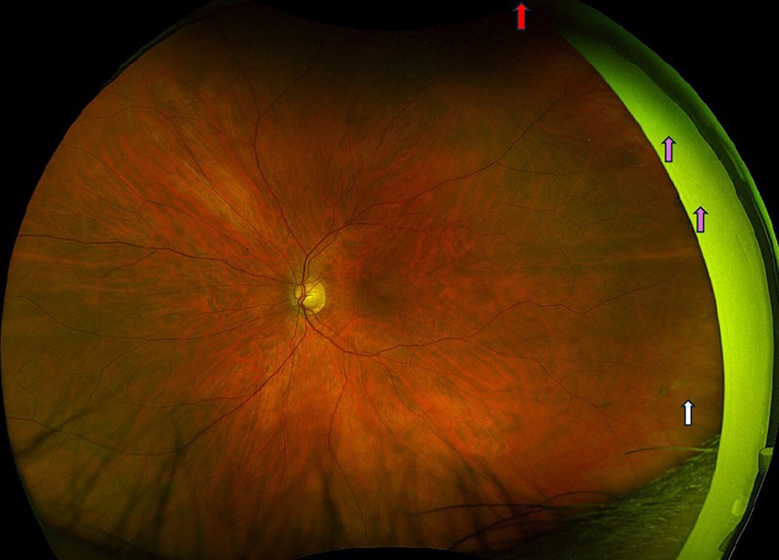 Posterior vitreous detachment: Minimising complications through ...
