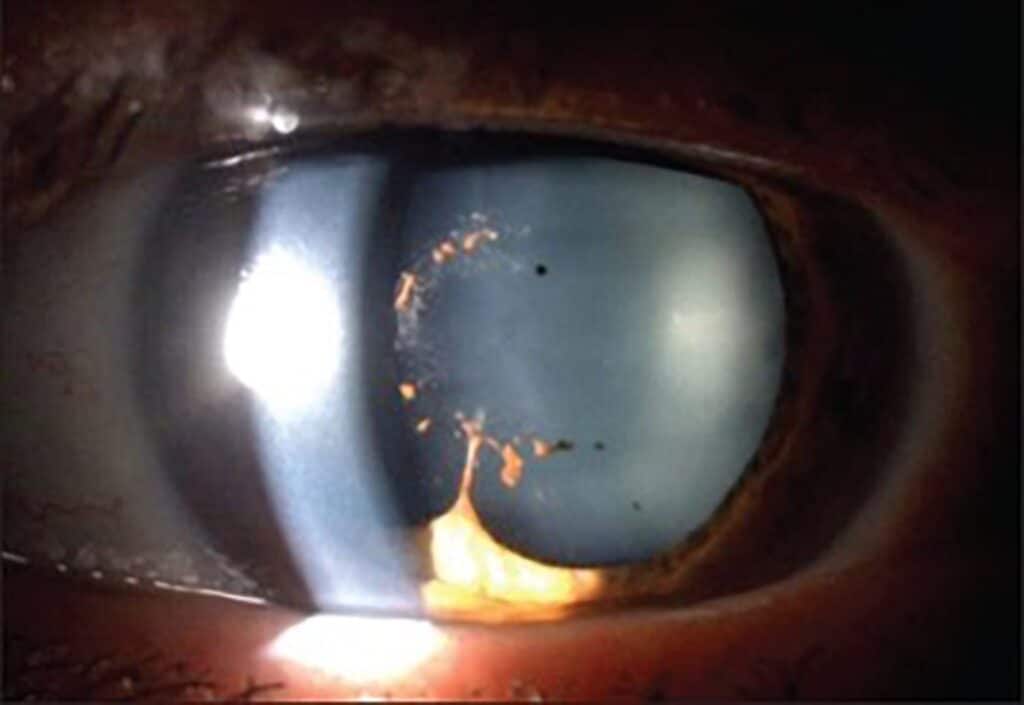 Uveitis guide for optometrists - Insight