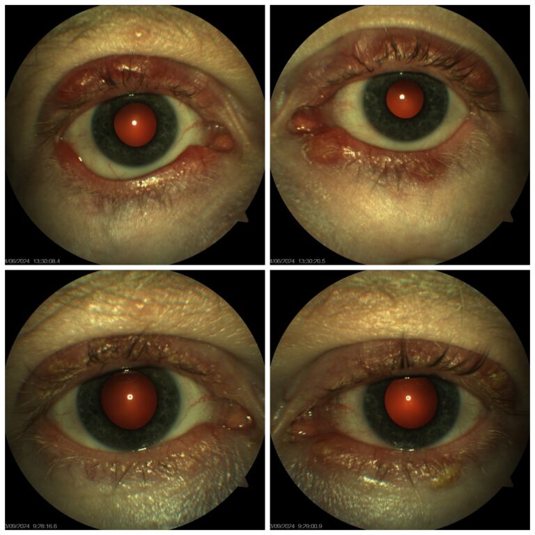 An Australian ophthalmologist's take on low light level therapy for dry ...