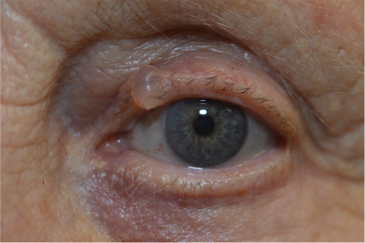 Recognising eyelid malignancies: A guide for optometrists - Insight