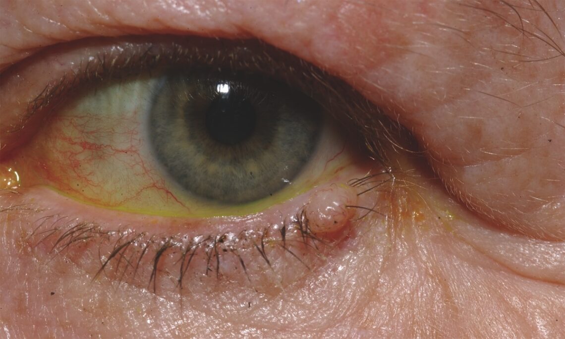 Recognising eyelid malignancies: A guide for optometrists - Insight