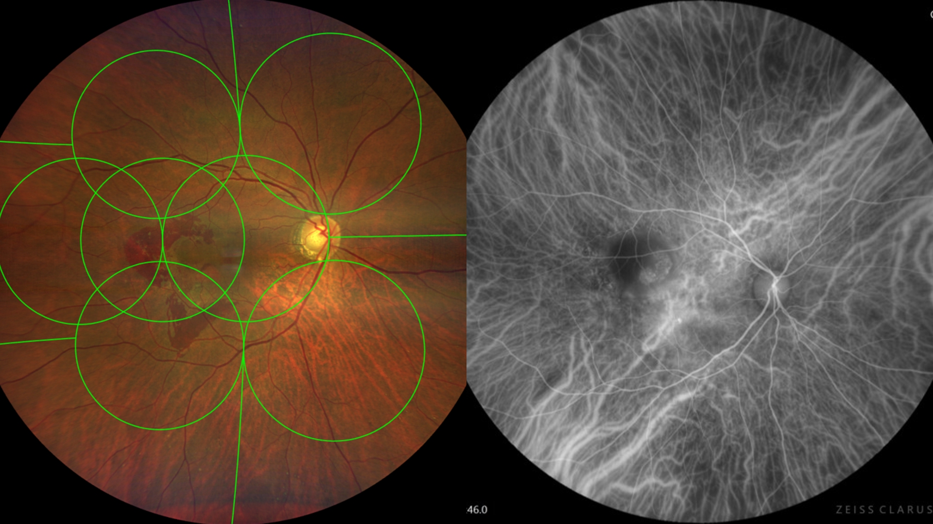 ZEISS launches ICG angiography for CLARUS 700 ultra-widefield imaging ...