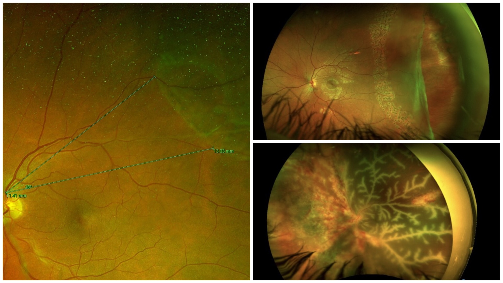 How Optos changed the way these ophthalmologists manage retinal disease ...